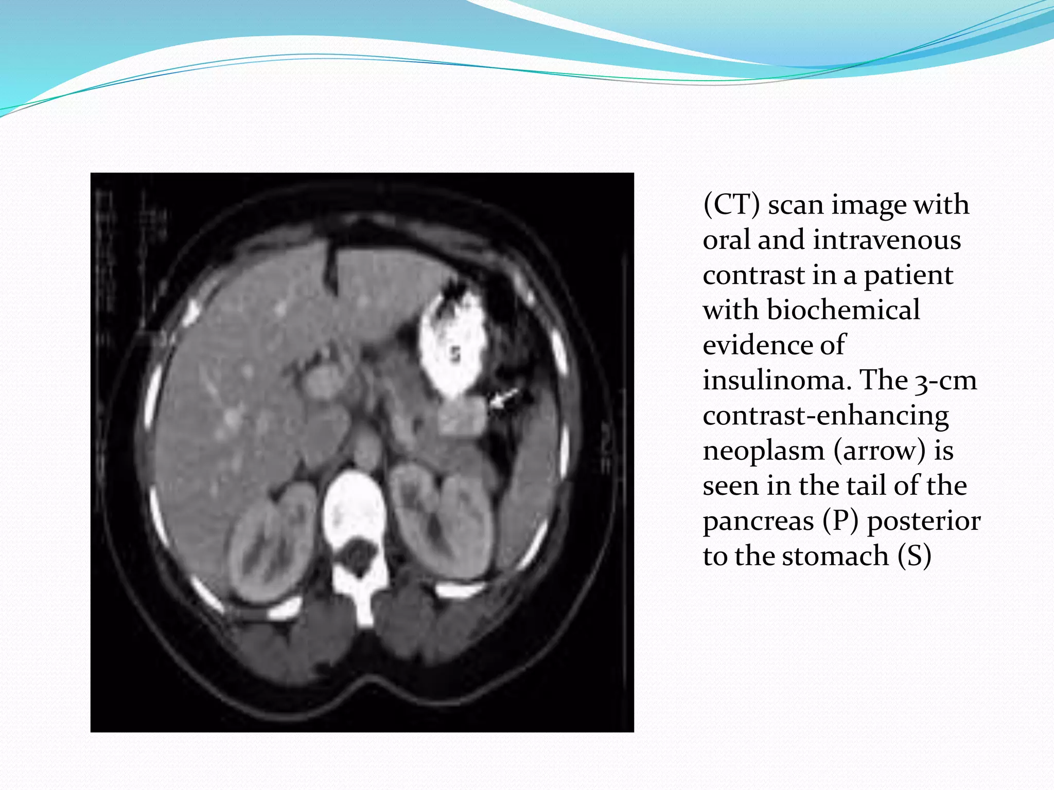 Multiple endocrine neoplasia (men) syndromes | PPTX