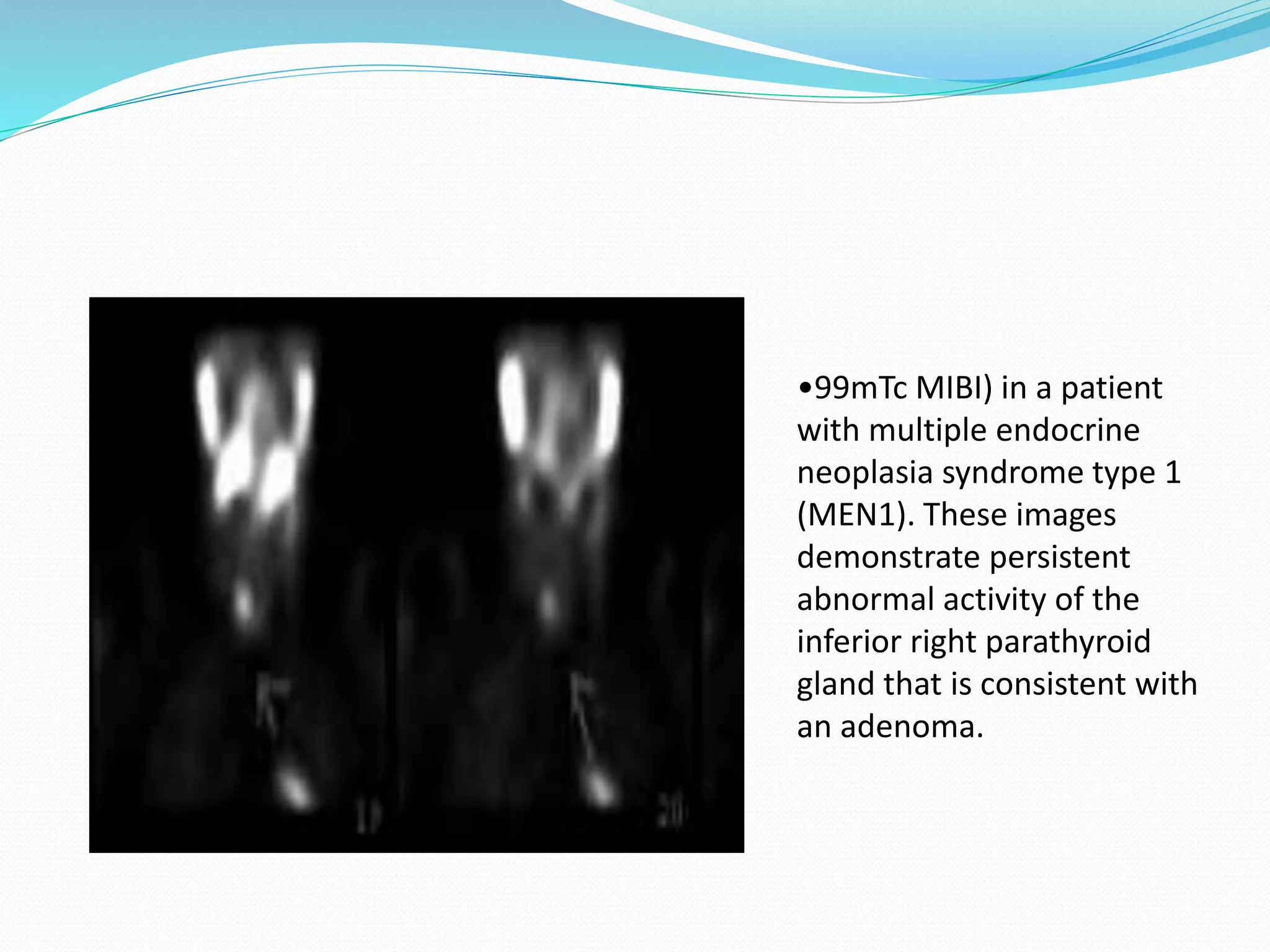 Multiple endocrine neoplasia (men) syndromes | PPTX