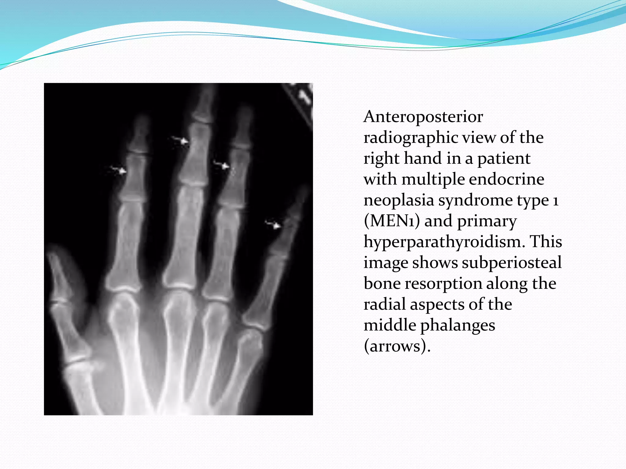 Multiple endocrine neoplasia (men) syndromes | PPTX