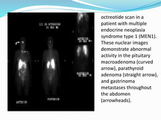Multiple endocrine neoplasia (men) syndromes | PPTX