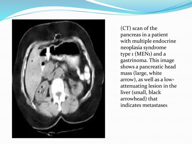 Multiple endocrine neoplasia (men) syndromes | PPTX | Endocrine and ...