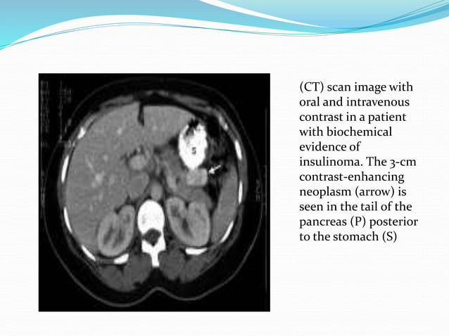 Multiple endocrine neoplasia (men) syndromes | PPTX | Endocrine and ...