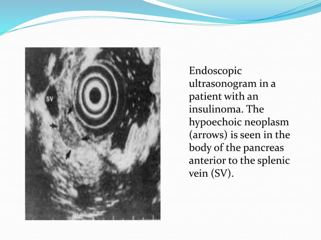 Multiple endocrine neoplasia (men) syndromes | PPTX | Endocrine and ...