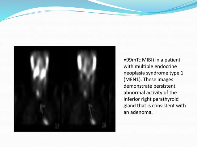 Multiple endocrine neoplasia (men) syndromes | PPTX | Endocrine and ...