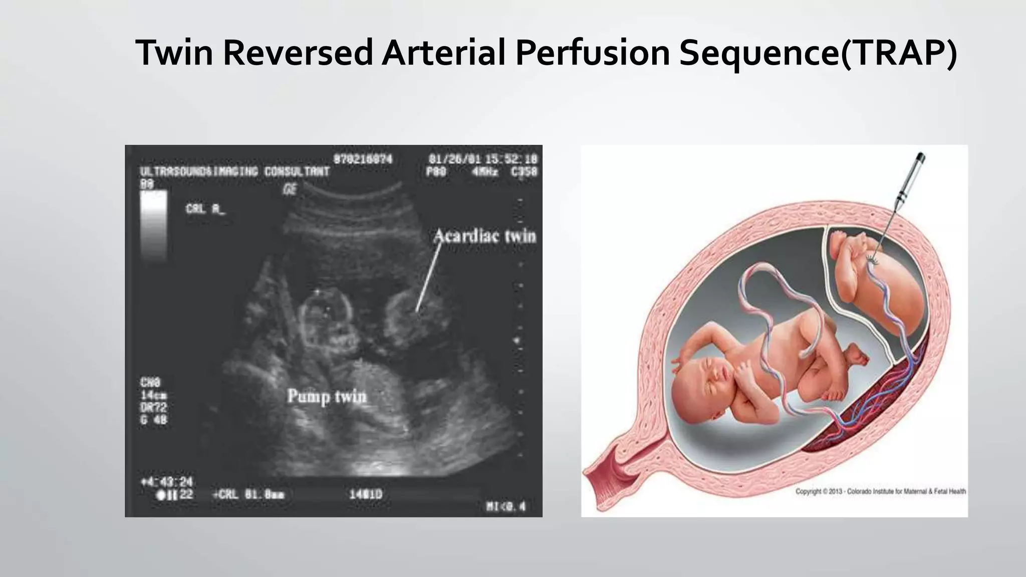 Multiple Gestation.pptx
