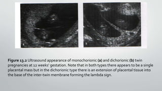 Multiple Gestation.pptx