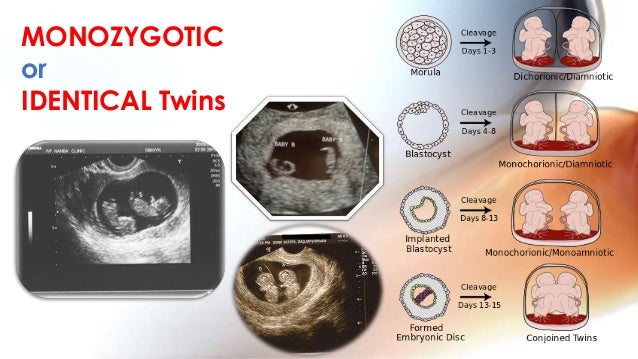 Multiple Gestations