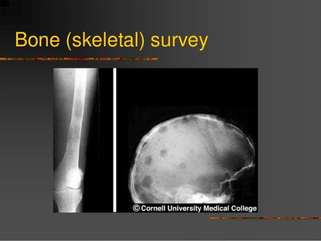 Multiple Myeloma