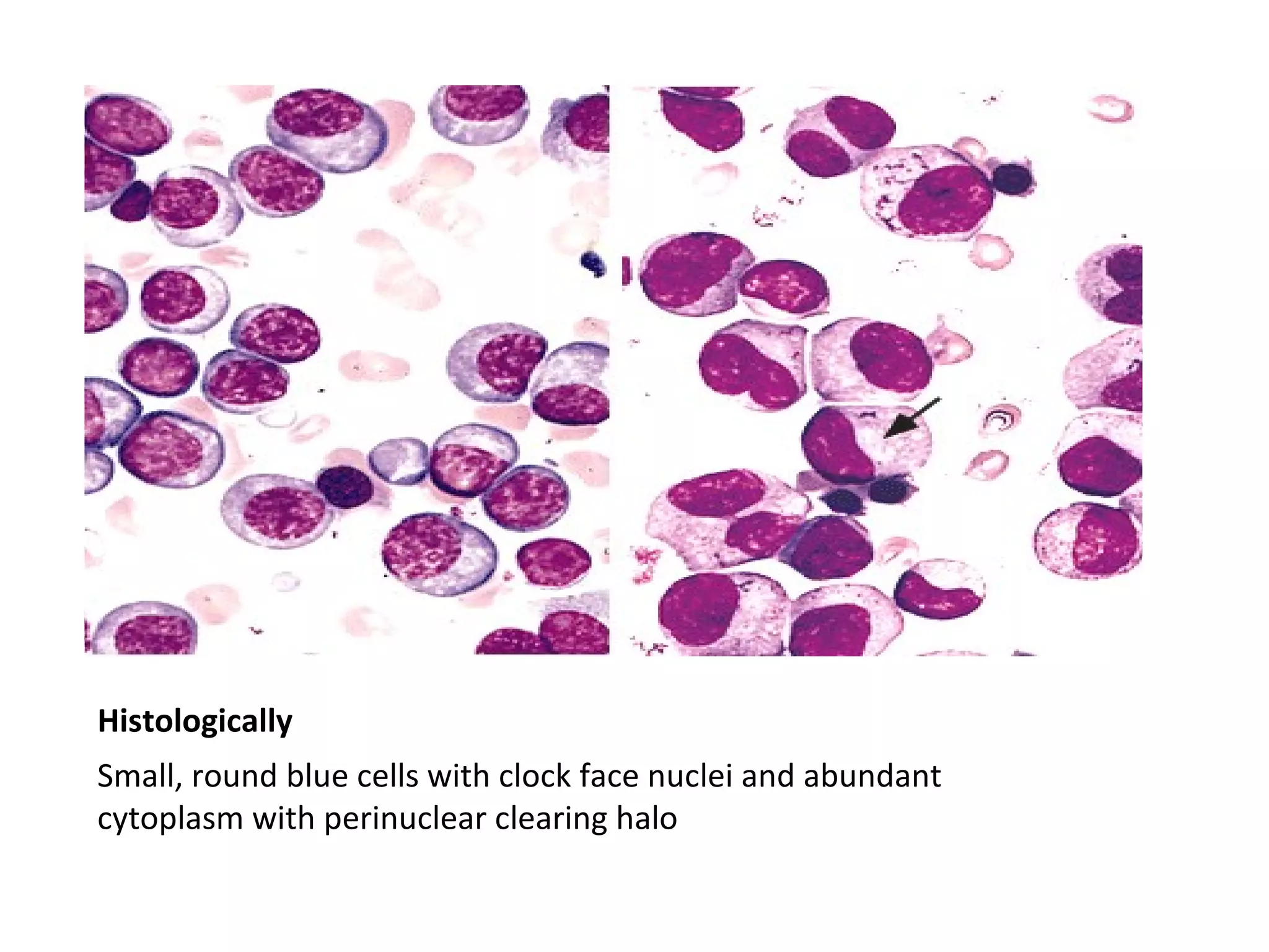 Multiple myeloma | PPT