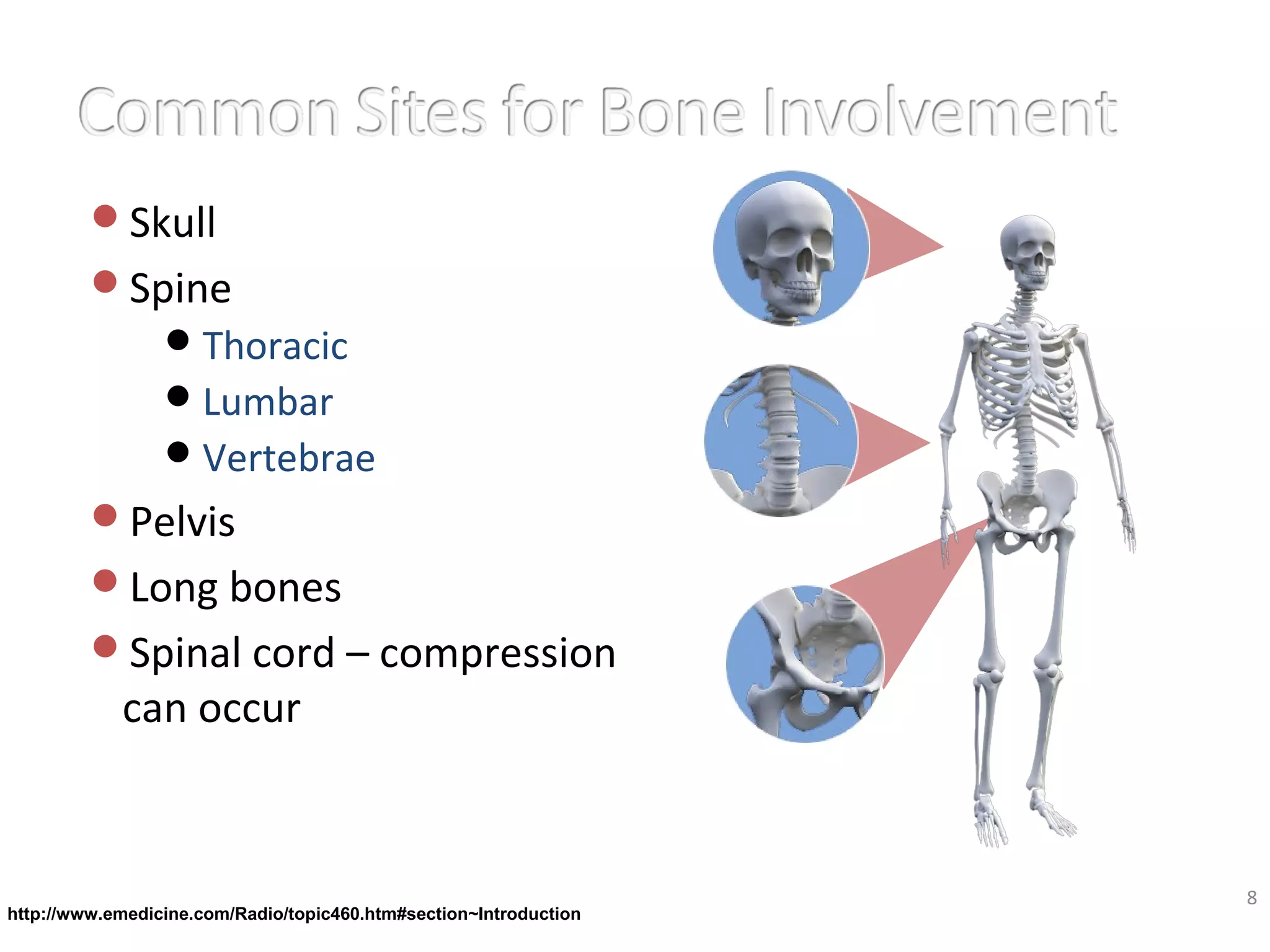 Multiple myeloma | PPT