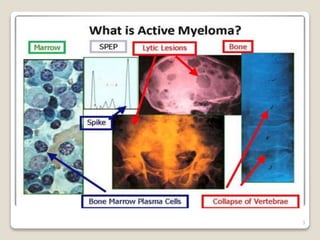 (Multiple Myeloma) MM | PPTX