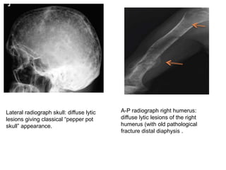 Multiple myeloma | PPTX