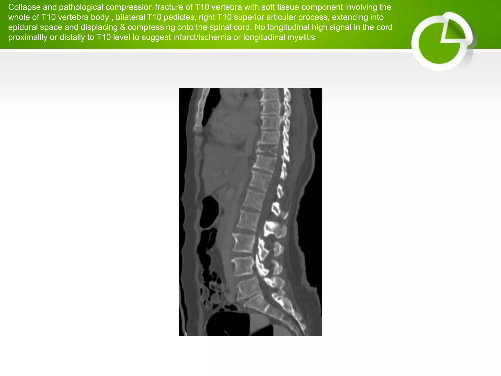 Multiple myeloma | PPTX