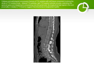 Multiple myeloma | PPTX