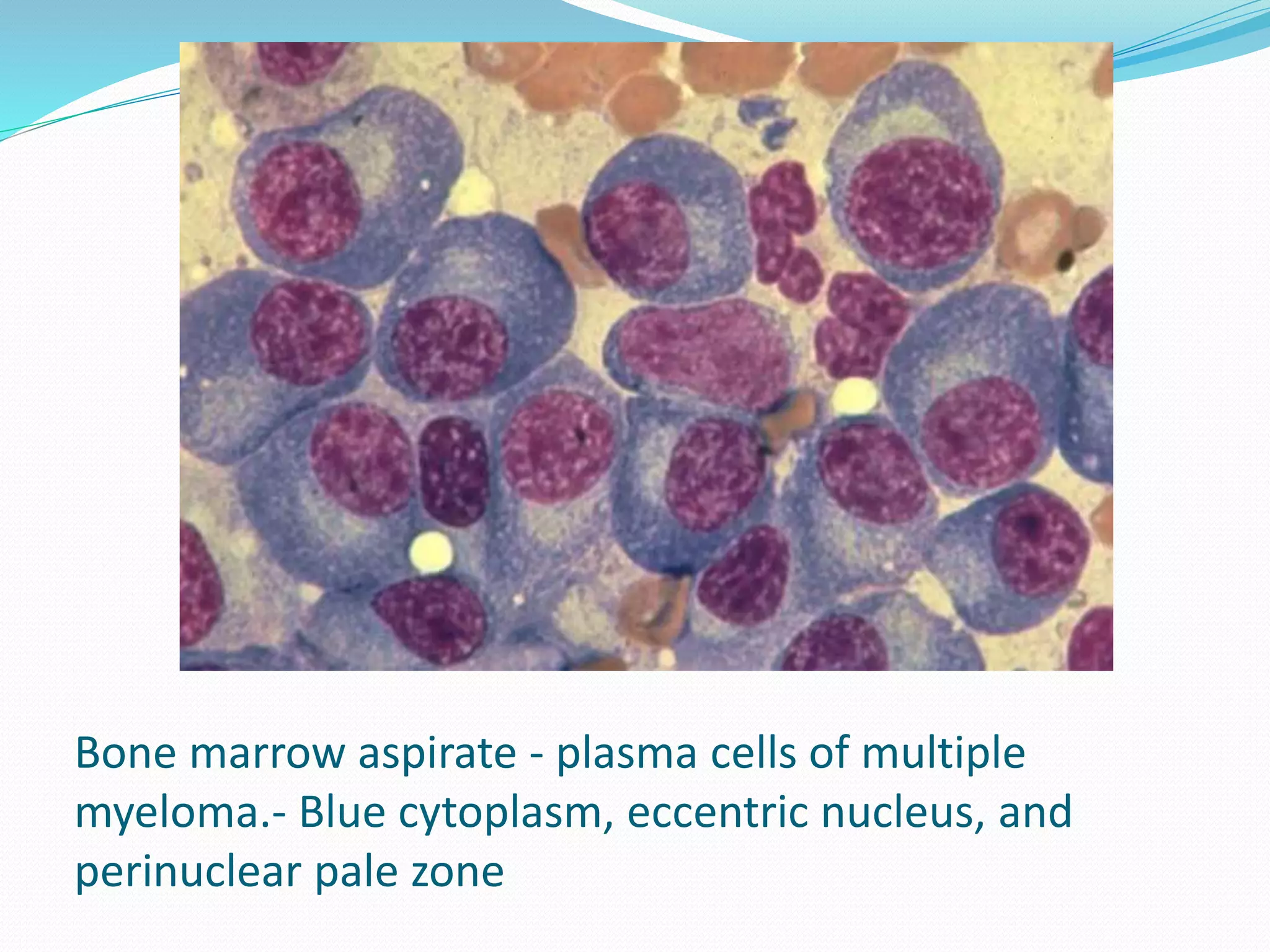 Multiple myeloma | PPTX
