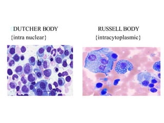 Multiple myeloma and its management | PPT