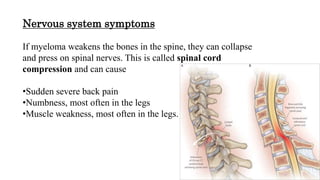 Multiple myeloma | PPTX