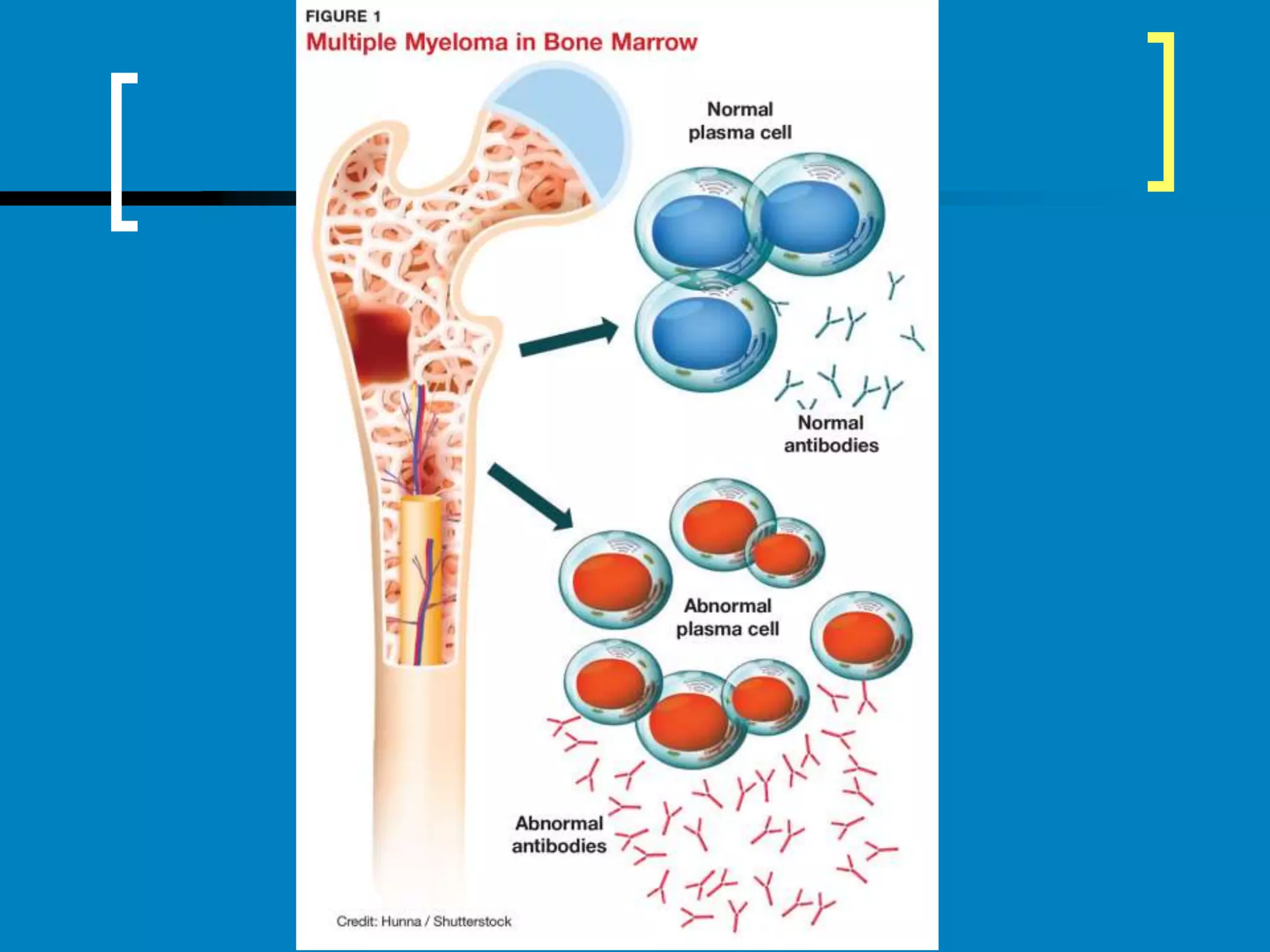 Multiple Myeloma.ppt