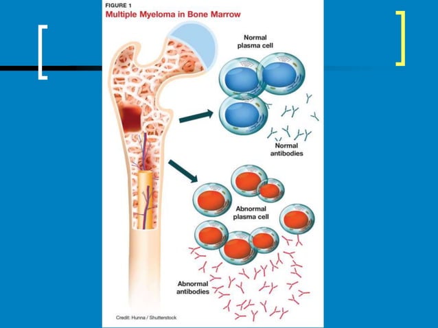 Multiple Myeloma.ppt