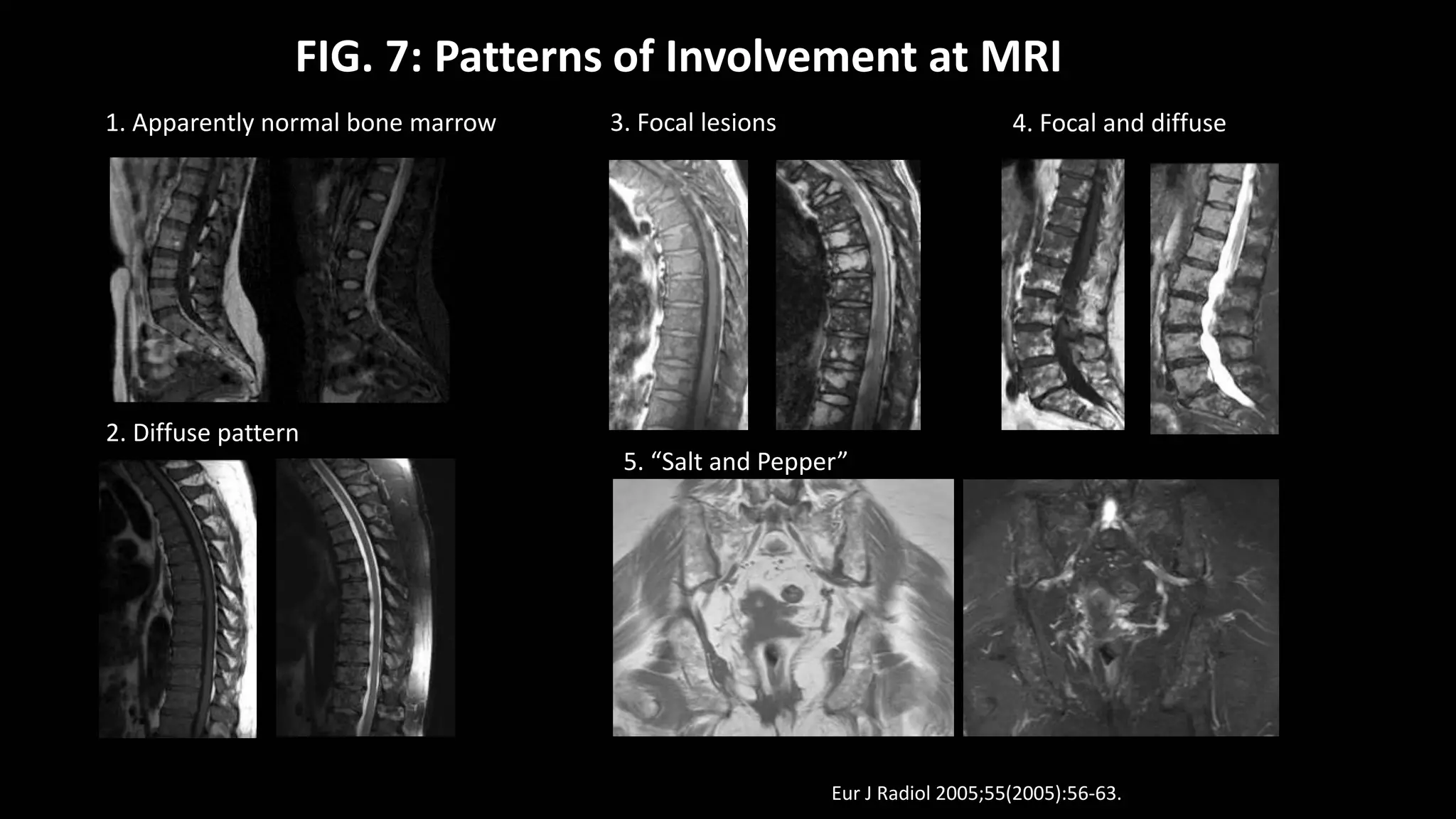 Multiple Myeloma.pptx
