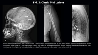 Multiple Myeloma.pptx
