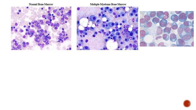 multiple myeloma features and findings including treatment | PPT