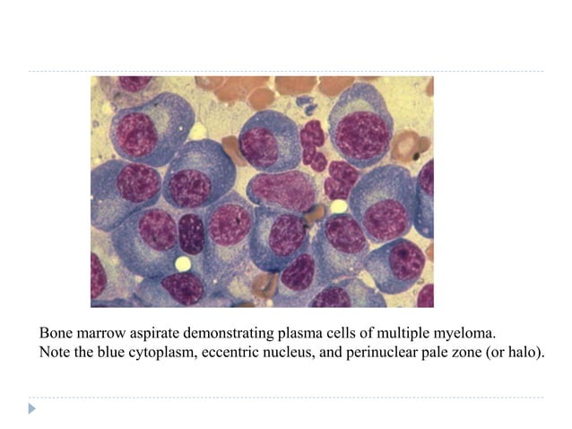 MULTIPLE MYELOMA clinical features and presentation.pptx