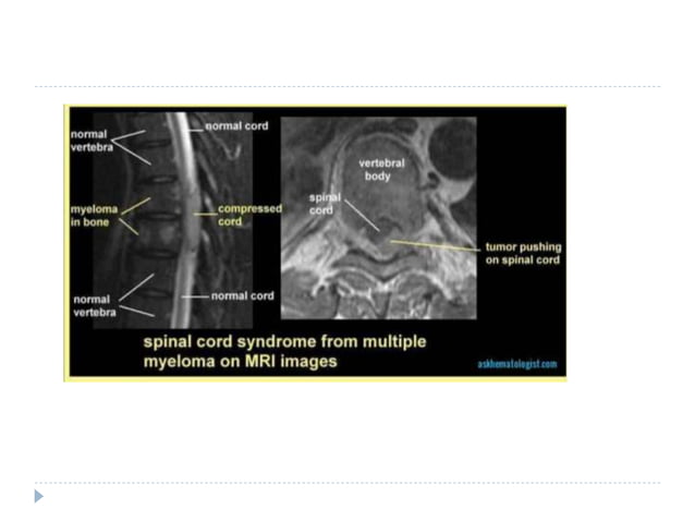 MULTIPLE MYELOMA clinical features and presentation.pptx