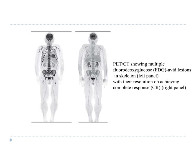 MULTIPLE MYELOMA clinical features and presentation.pptx