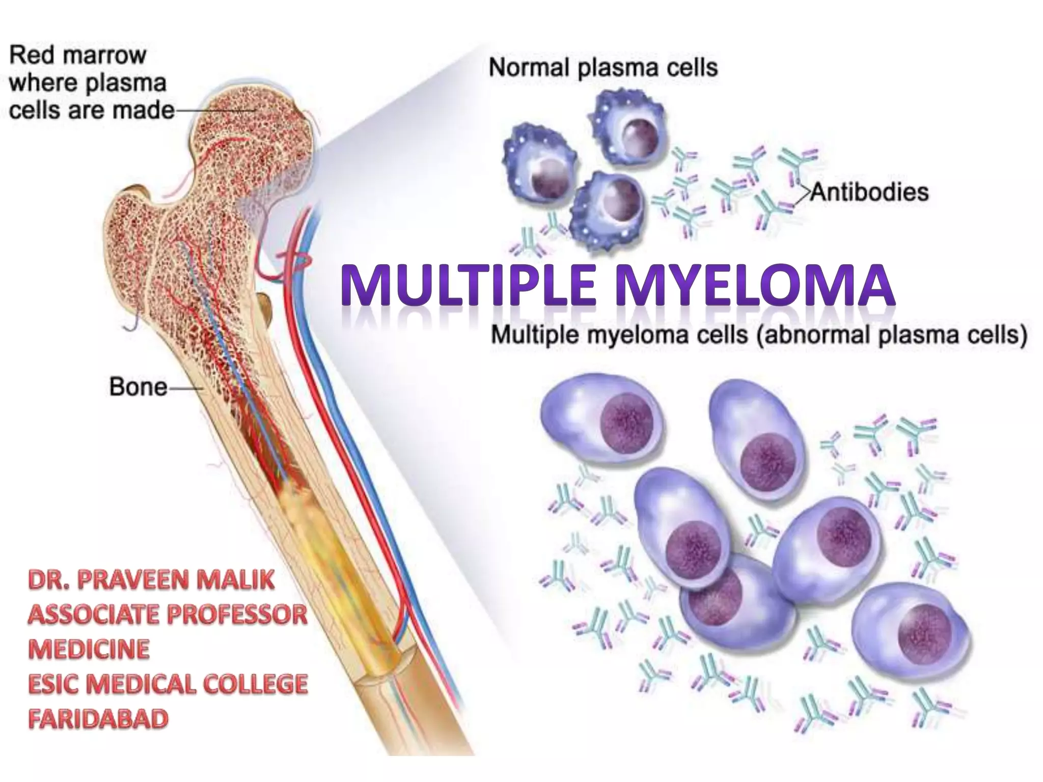 Multiple myeloma[1] | PPT