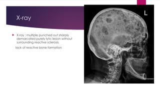 Multiple myeloma is hematological disorder affecting plasma cells ...