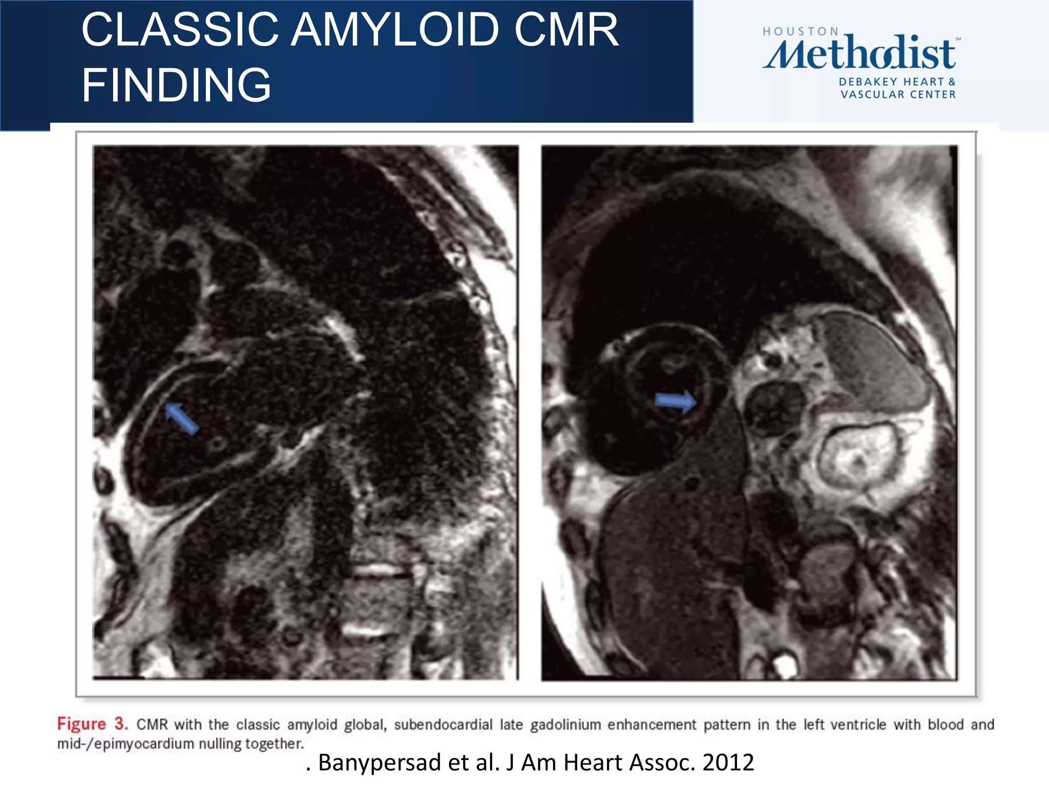 Multiple myeloma and al amyloidosis | PDF