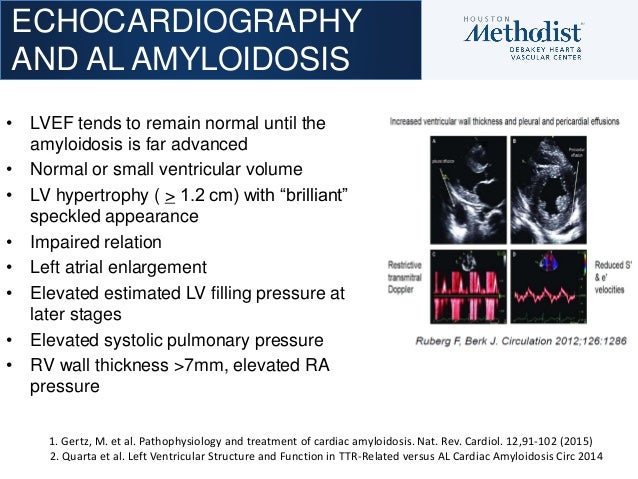 Multiple myeloma and al amyloidosis