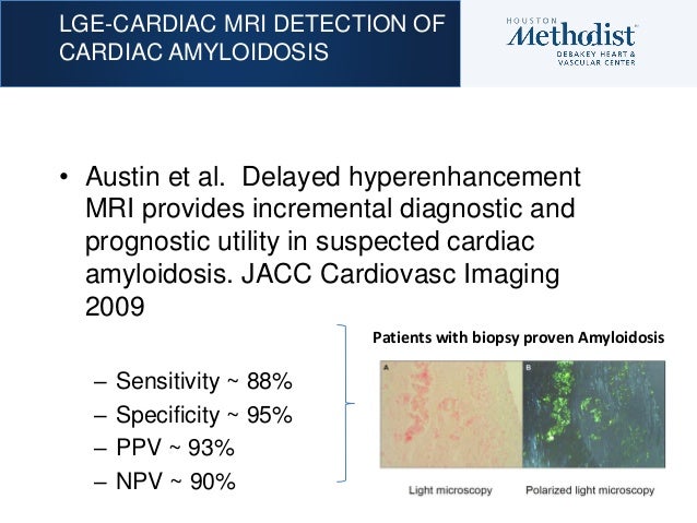 Multiple Myeloma And Al Amyloidosis