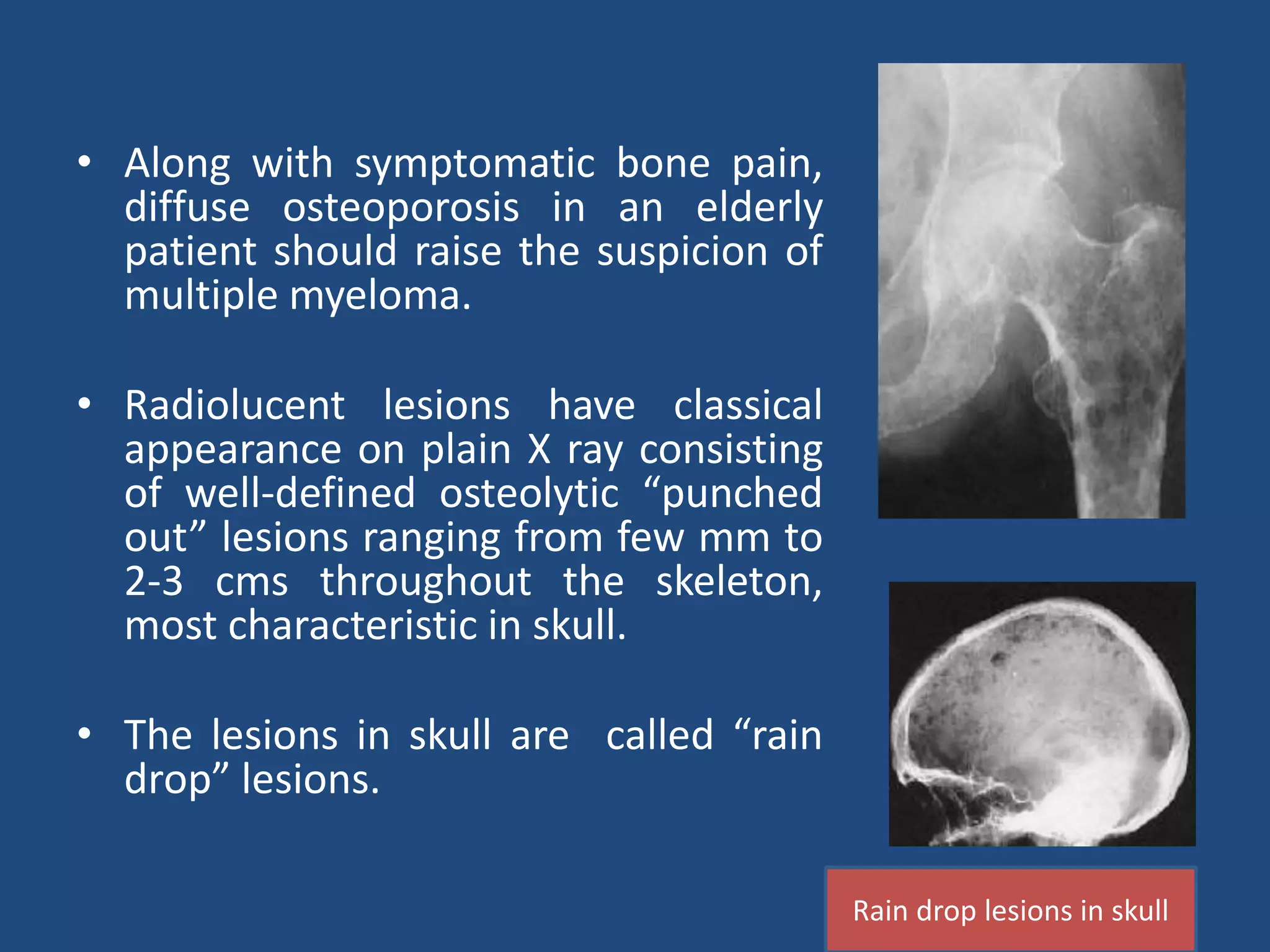 Case Presentation on Multiple Myeloma by Dr. Brajesh K. Ben | PPTX