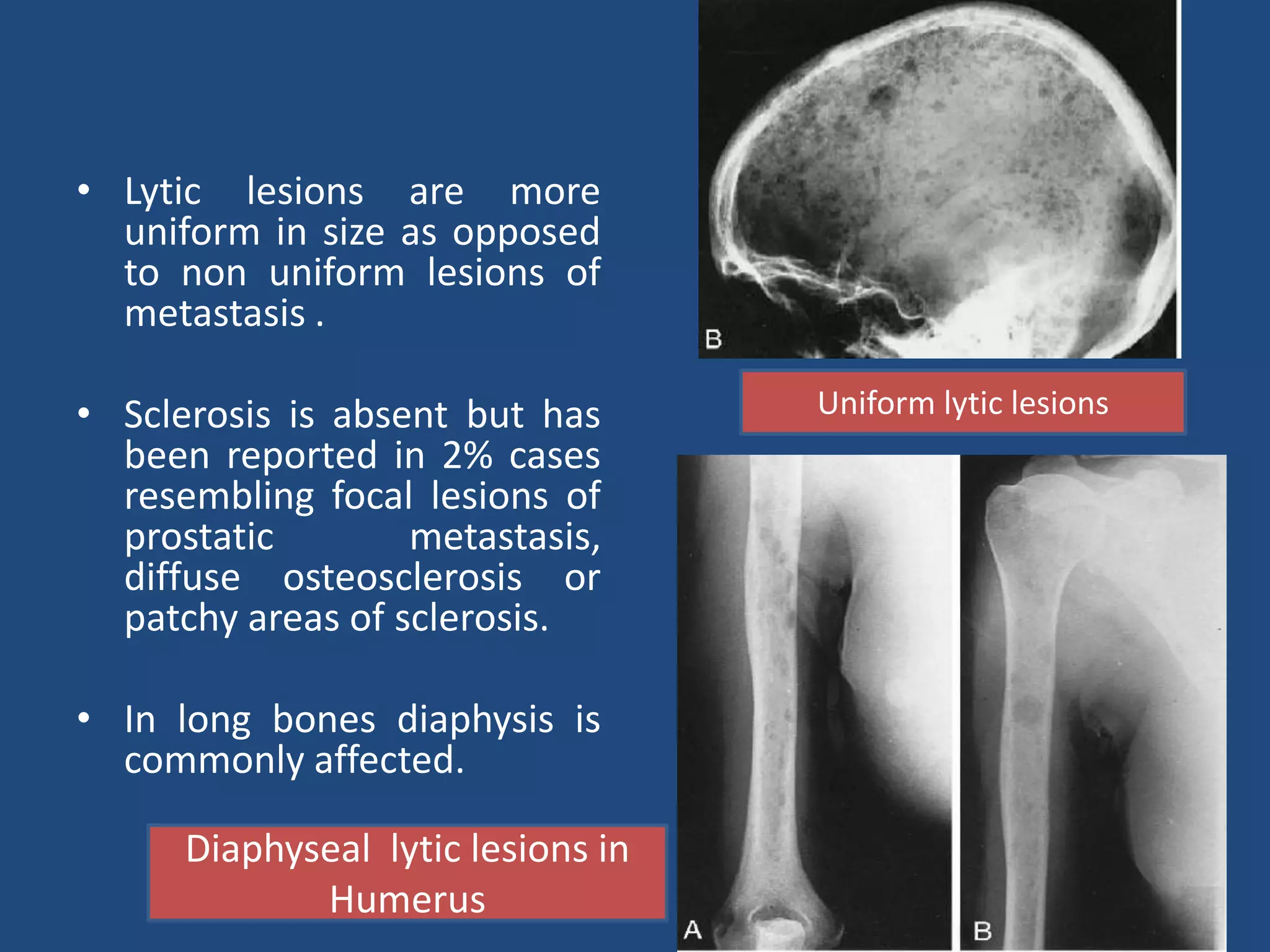 Case Presentation on Multiple Myeloma by Dr. Brajesh K. Ben | PPTX