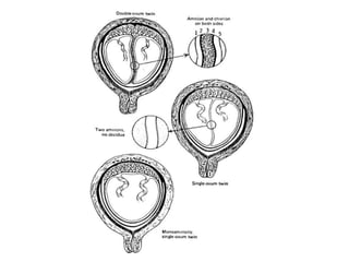 Multiple pregnancy | PPTX