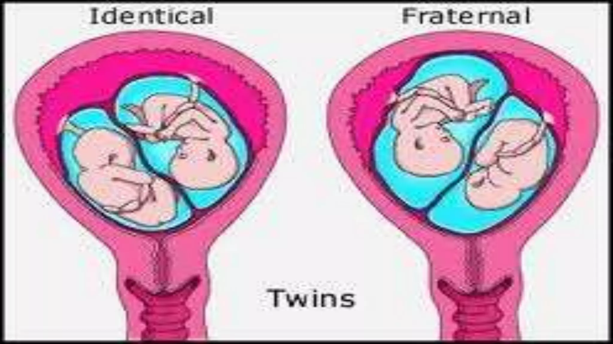 Multiple pregnancy | PPTX