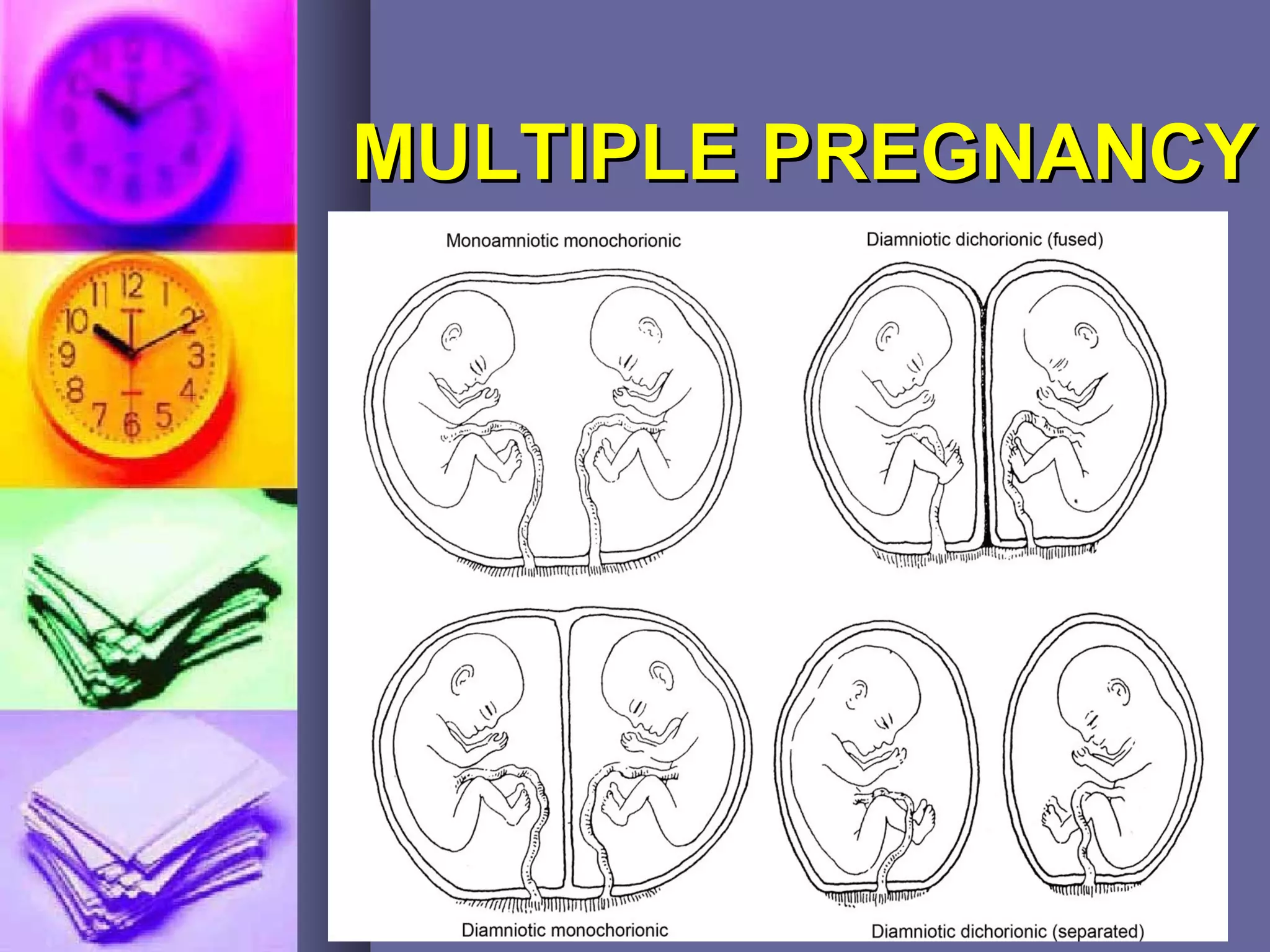 Multiple pregnancy | PPT