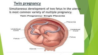 MULTIPLE PREGNANCY, obstetrics and Gynecologist.pptx