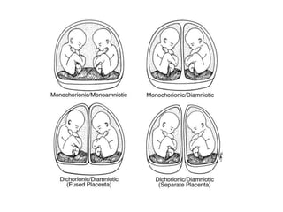 Multiple_Pregnancy.ppt