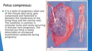 multiple pregnancy its sign symptoms and management.pdf
