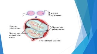 multiple pregnancy its sign symptoms and management.pdf