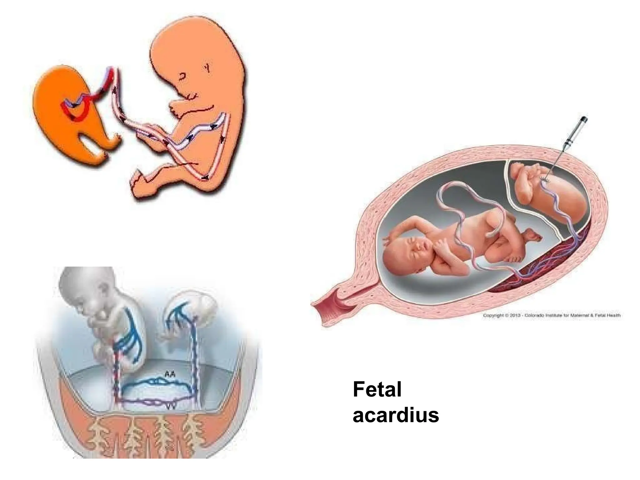 Multiple pregnancy including MCDA and MCMA.pptx