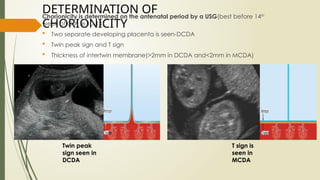 multiple pregnancy ,yamala garbha bams 3rd year | PPTX