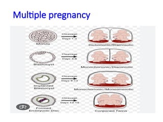 multiple pregnancy B.sc., Nursing student | PPTX