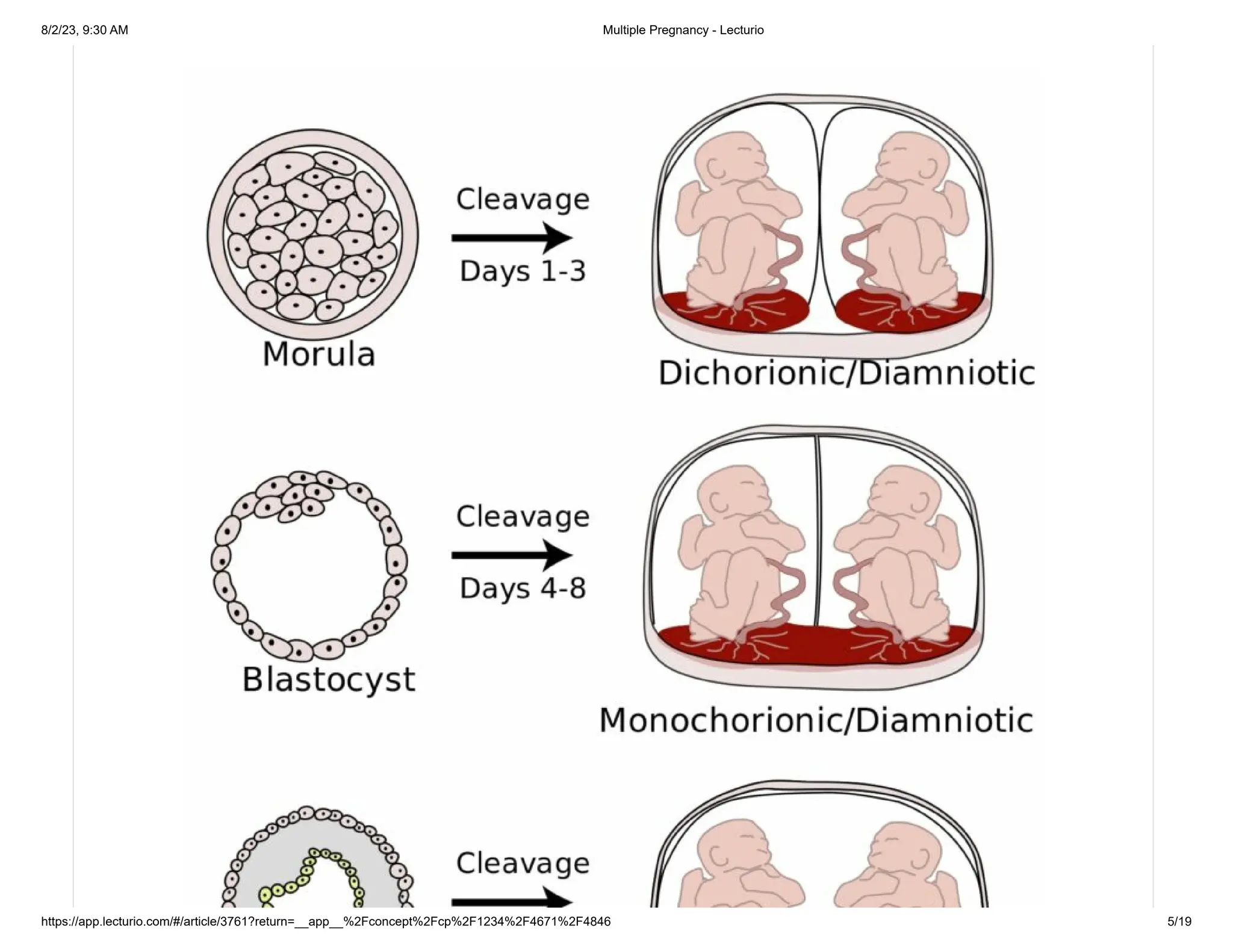 Multiple Pregnancy Lecturio professor.pdf