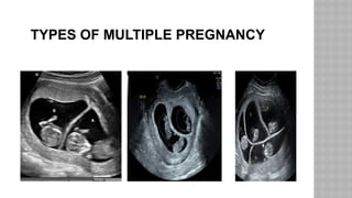 Multiple pregnancy (2).pptx Obstetrics and Gynaecology | PPTX