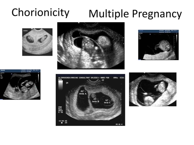 Multiple pregnancy malpresentation malposition | PPT