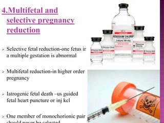 Multiple pregnancy – management | PPTX | Pregnancy | Reproductive Health